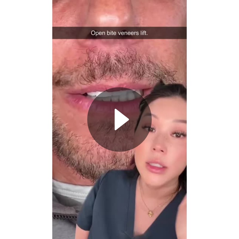 Transforming smiles with open bite veneers. | Dr. Joyce Kahng ...